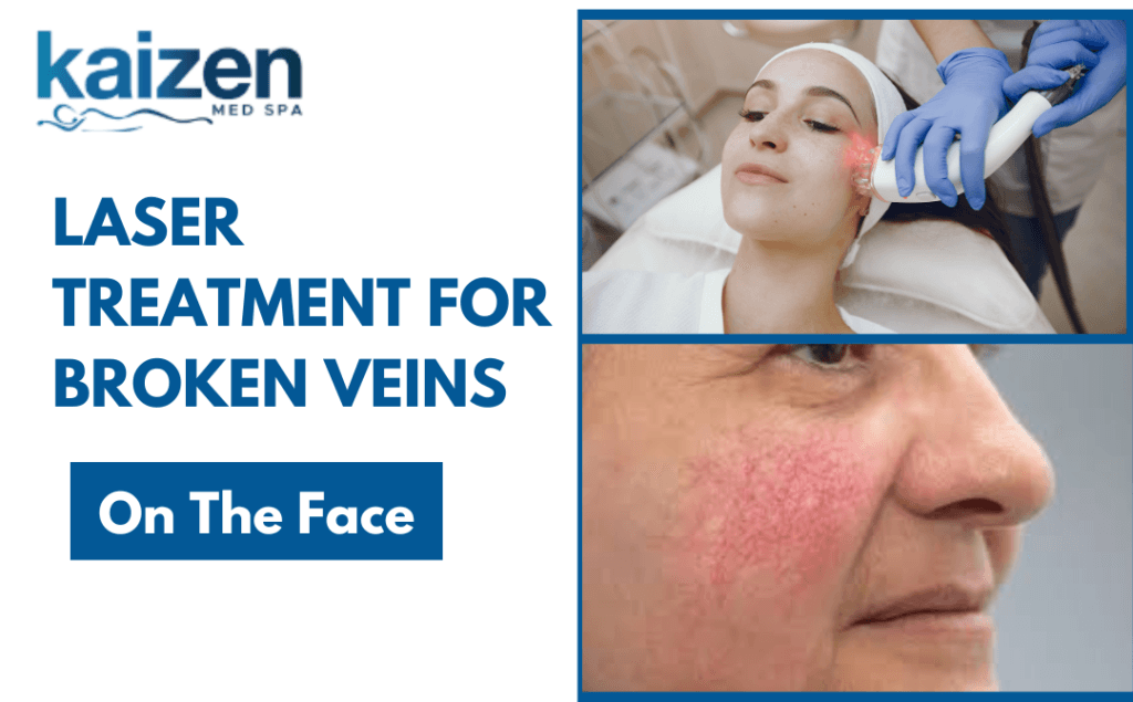 Laser Treatment for Broken Veins on the Face